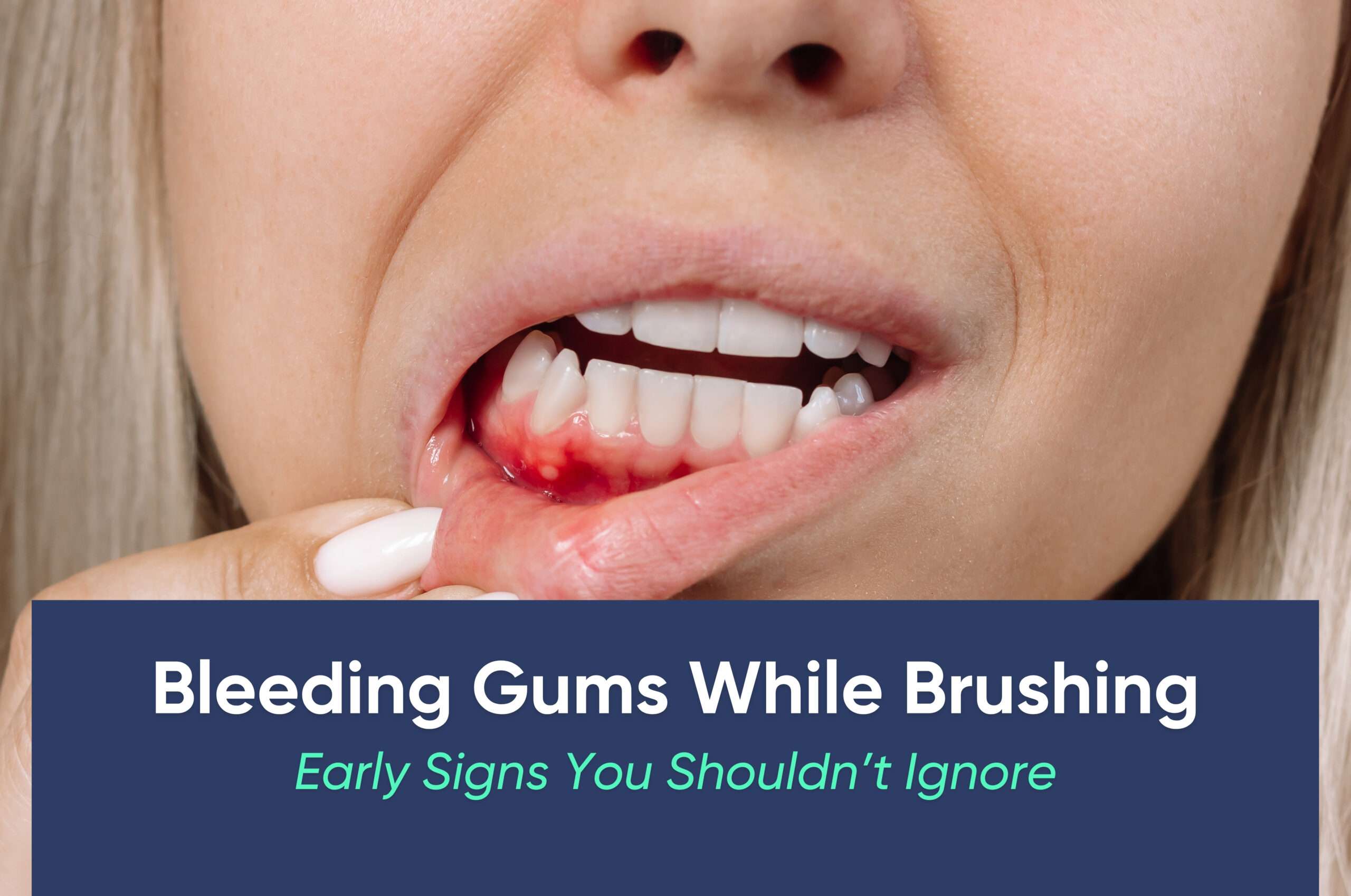 Bleeding Gums While Brushing: Causes, Risks, and Care